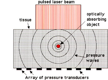 Chapter 18: Laser Optoacoustic Imaging | GlobalSpec